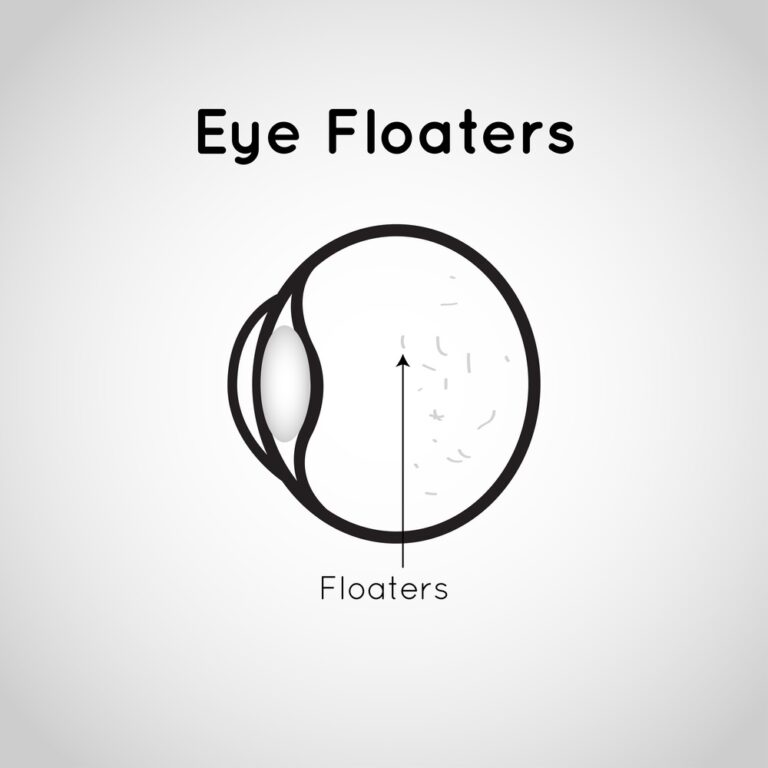 Causes of Eye Floaters - Dr. John D. Bissell O.D.